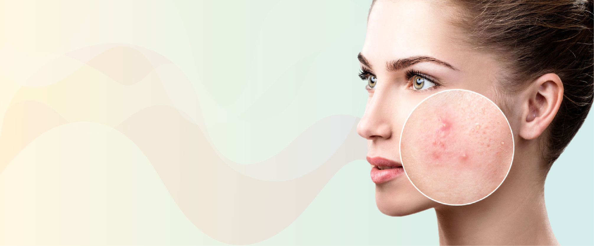 The Best Acne Treatment Products and Kits | Gold Cosmetics